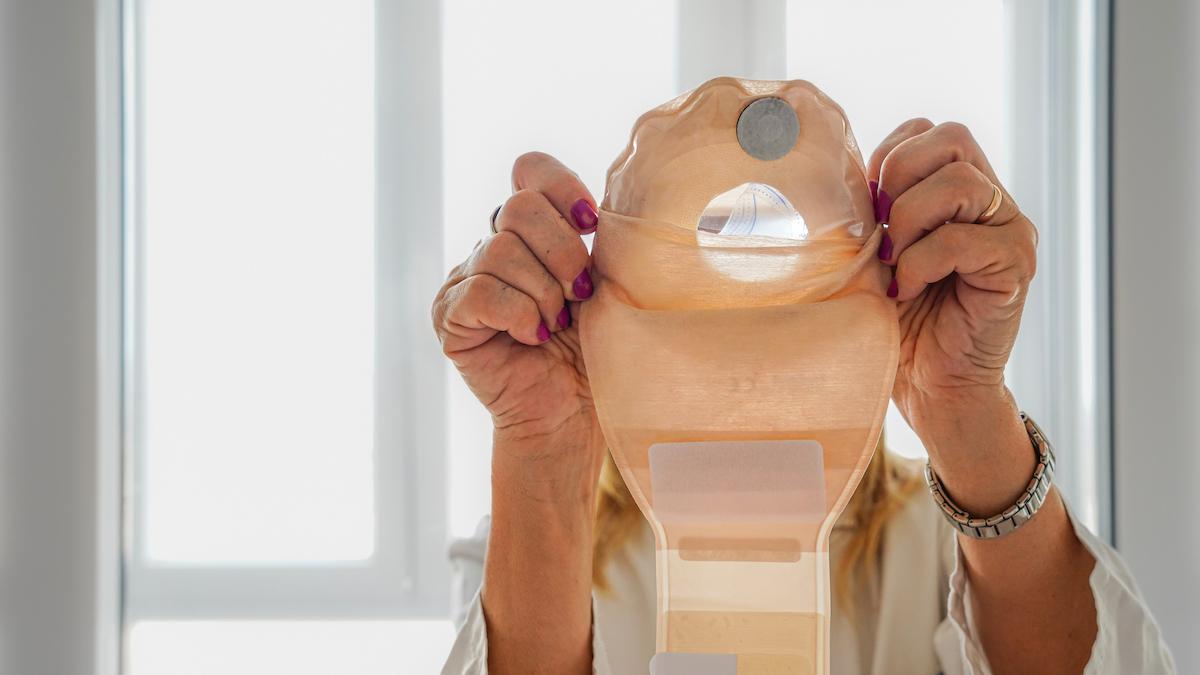 Ileostomia: cos'è, quando si fa e per quali malattie | Gazzetta.it