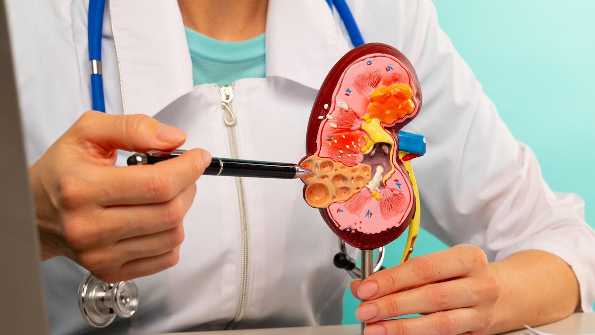 Calcolo renale: cos'è, rimedi e tempi di recupero dopo colica | Gazzetta.it