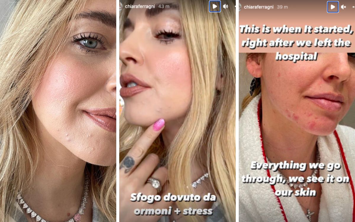 Chiara Ferragni, sfogo sul viso per stress e ormoni: il suo messaggio ...