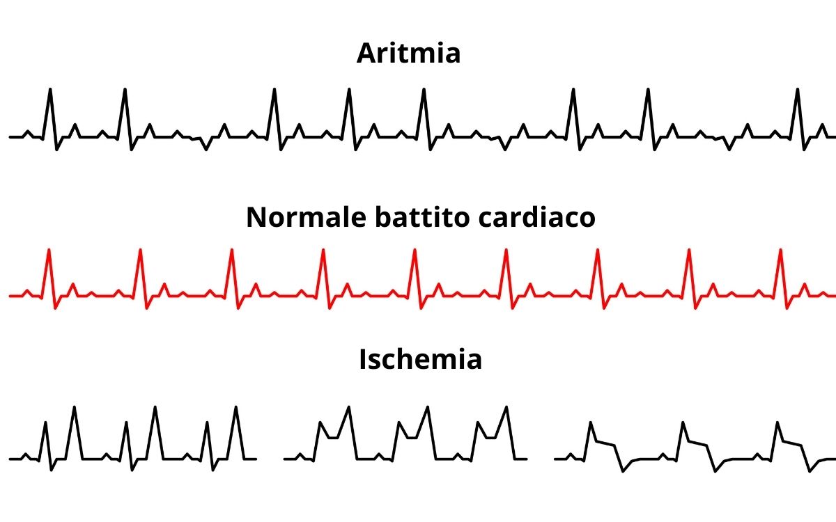 Aritmie e sport: come prevenire morti improvvise di atleti e non solo ...