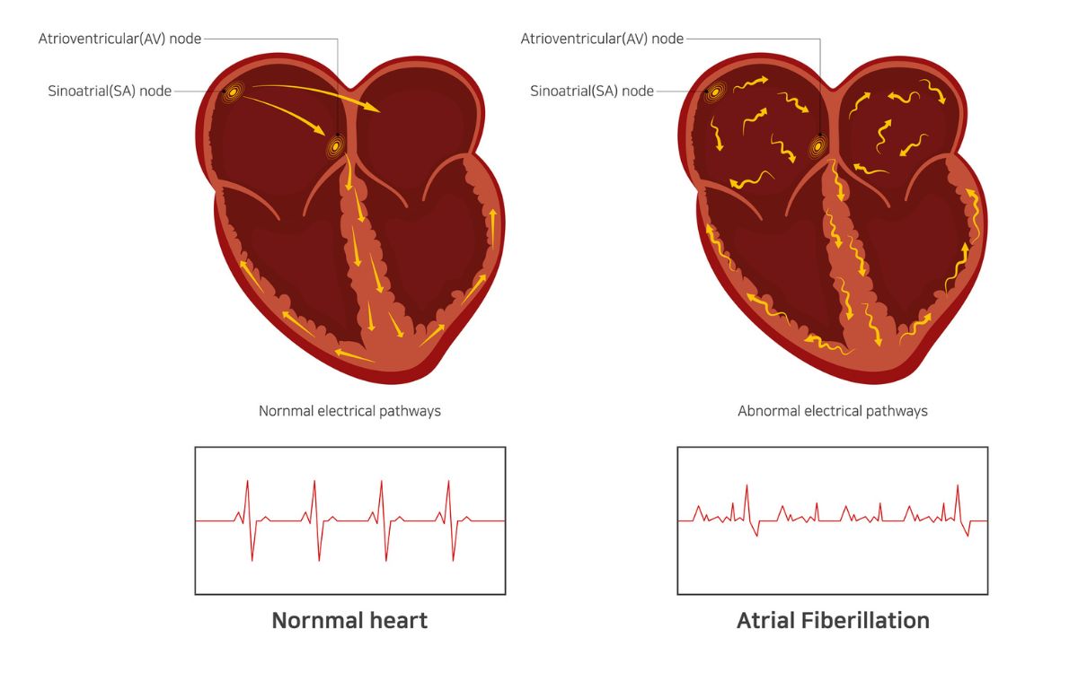 Aritmie cardiache: il libro per tutti su sintomi e prevenzione ...