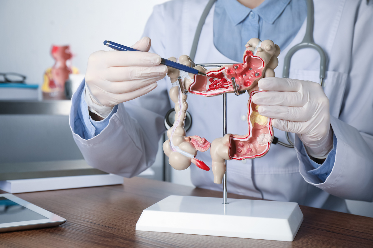 Cancro al colon: 4 sintomi da non trascurare per chi ha meno di 50 anni ...