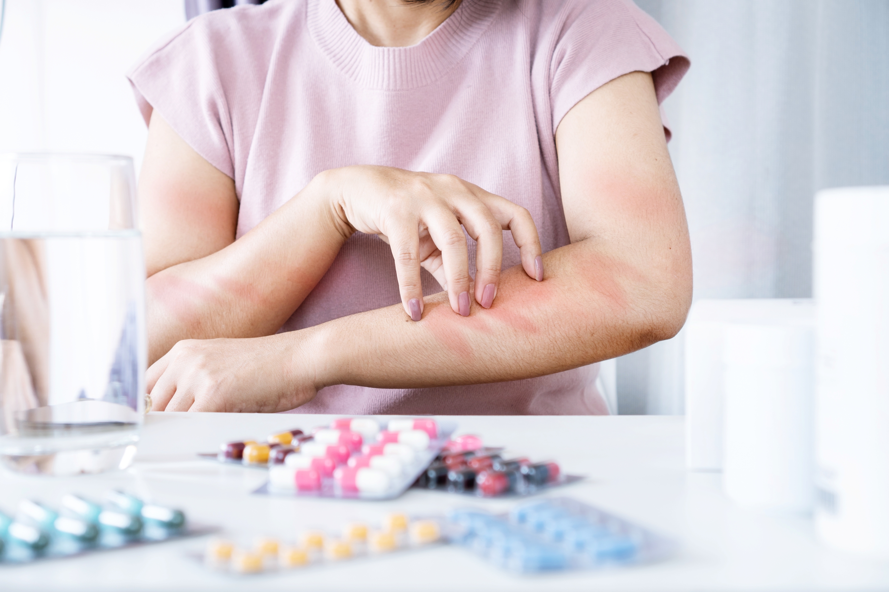 Orticaria: cause, sintomi, immagini dei pomfi. I consigli dell'esperta ...