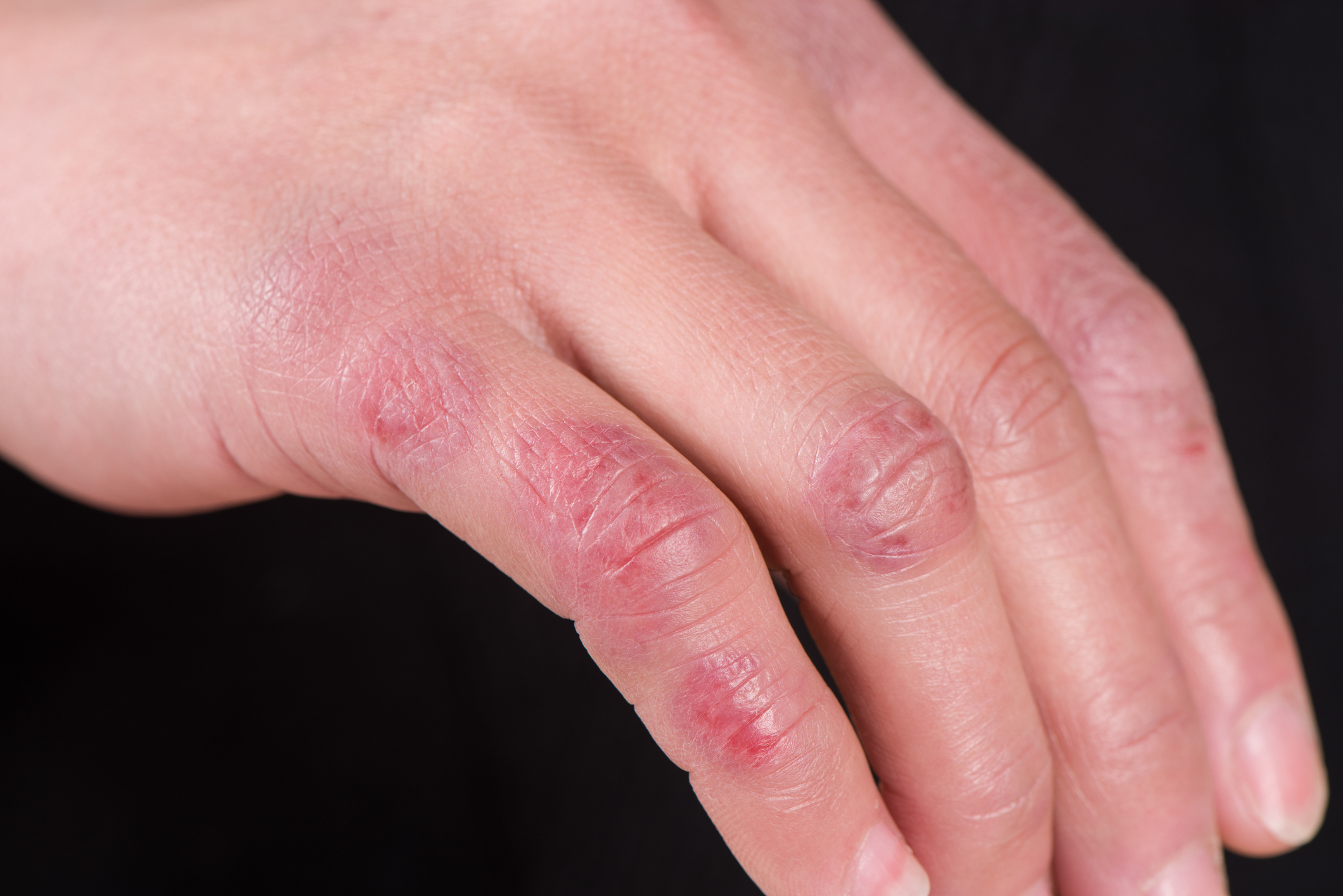 Geloni: sintomi, cure, rimedi. Come riconoscerli e combatterli ...