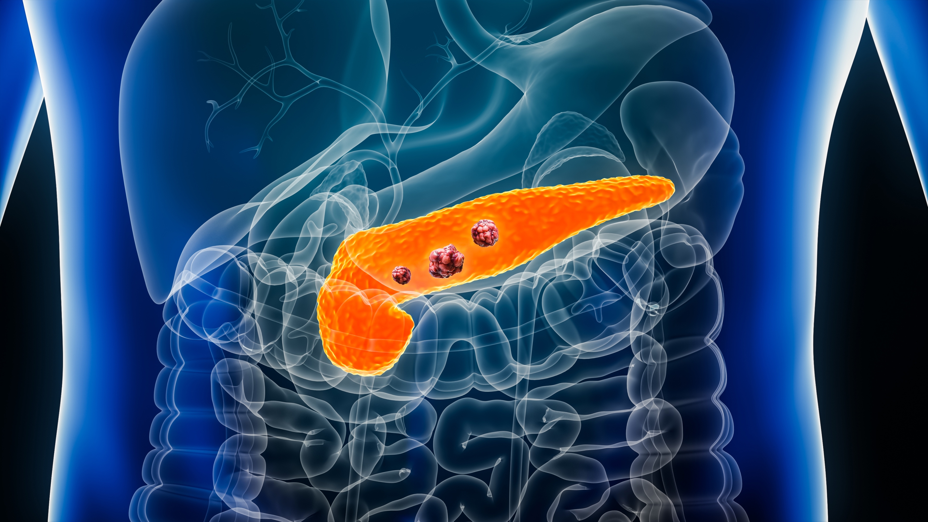 Tumore al pancreas: nuovo farmaco raddoppia la sopravvivenza al cancro ...