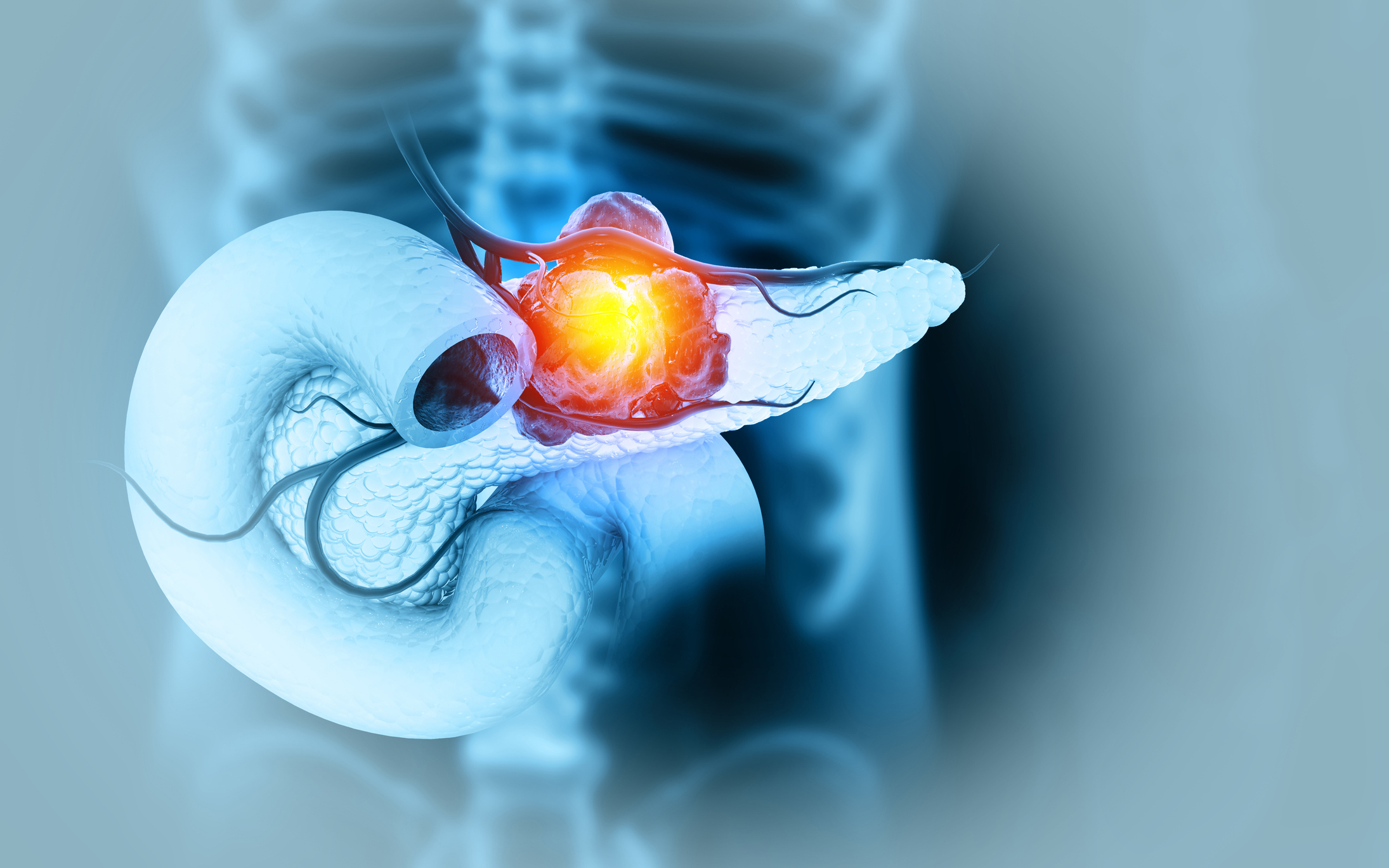 Tumore al pancreas, dai primi sintomi alle cure più innovative ...