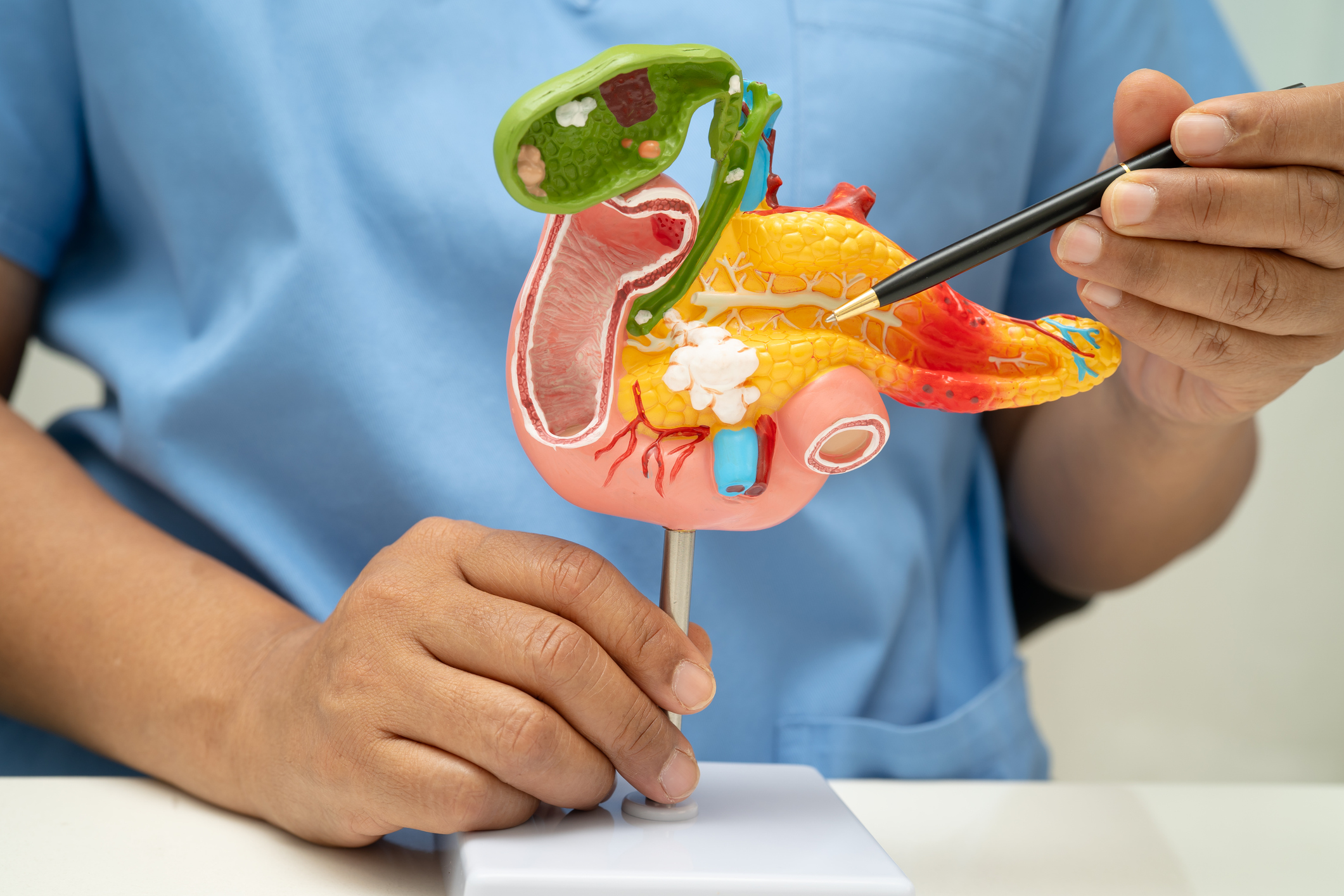 Tumore al pancreas: una 70enne salva grazie al vaccino a mRna | Gazzetta.it