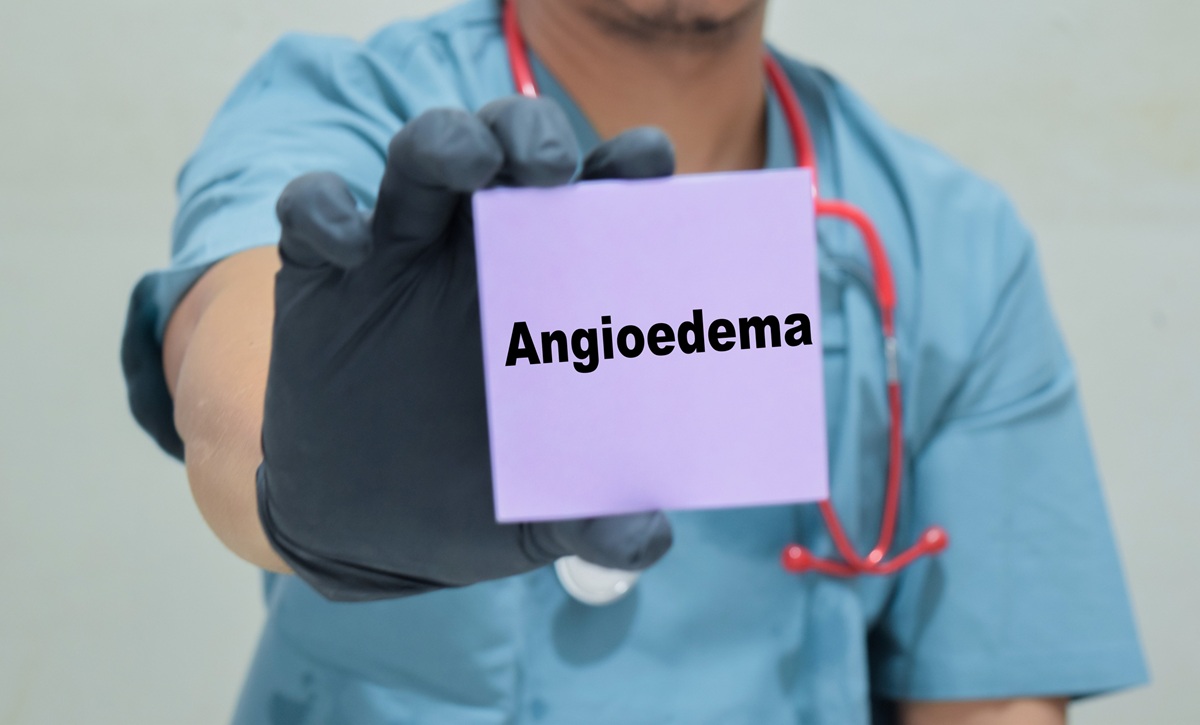 Angioedema ereditario: sintomi e come non confonderlo con allergia ...